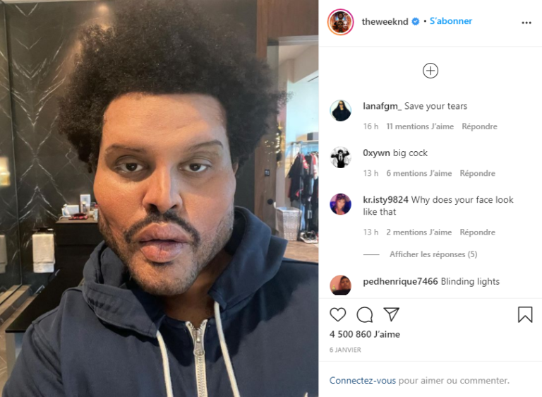 The weeknd visage métamorphosé : chirurgie esthetique ou non